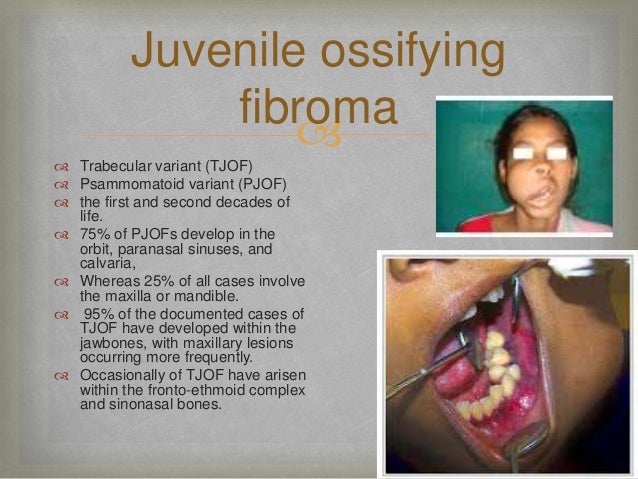 Ossifying Fibroma Histology