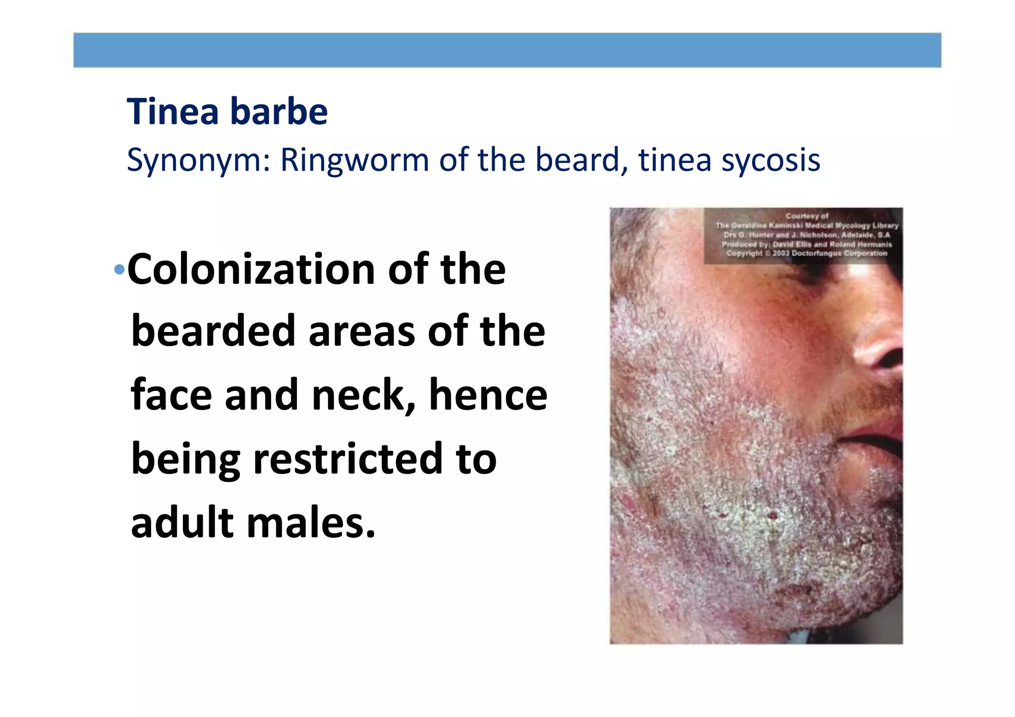 Pathology of fungal infection | PPTX