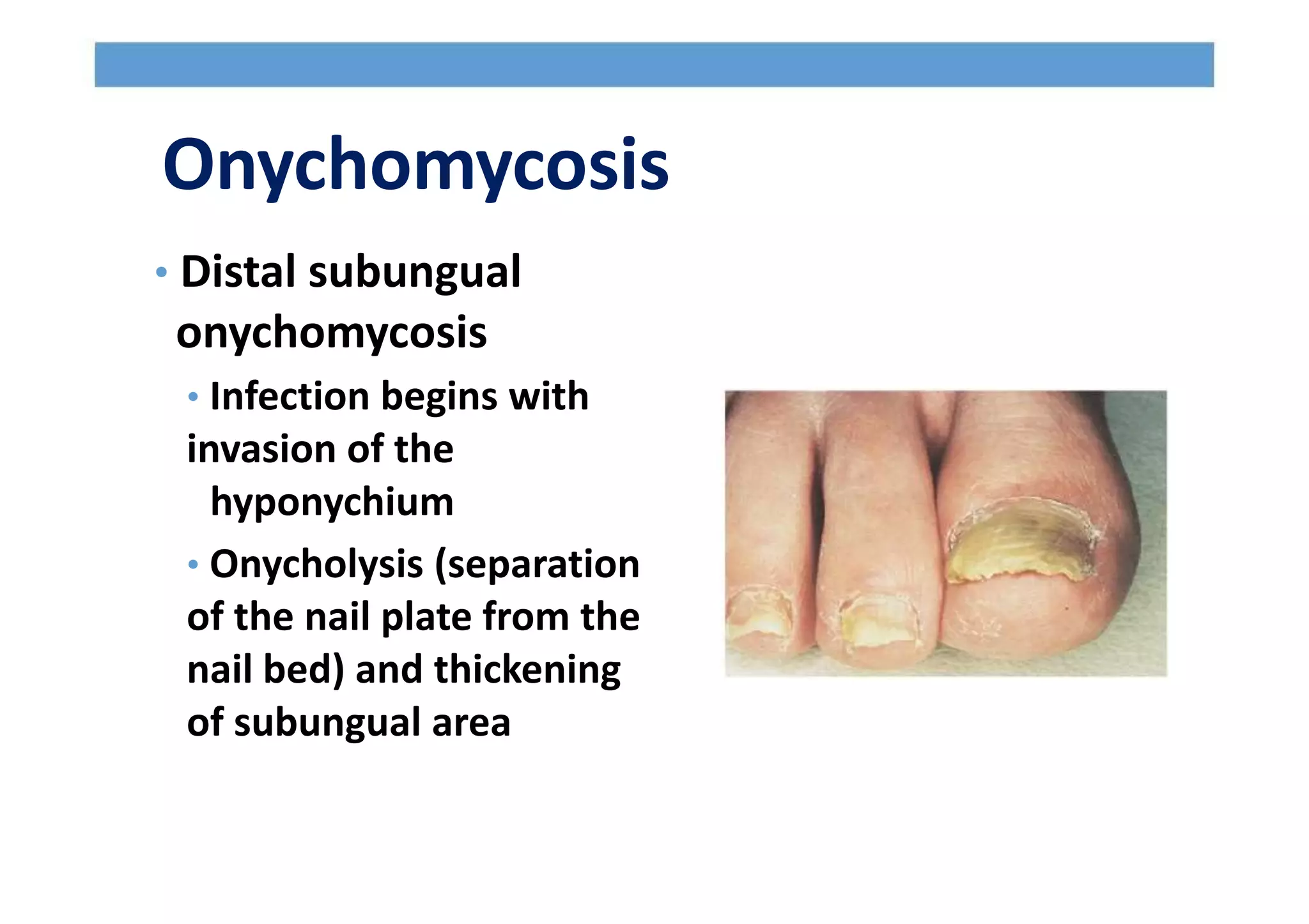 Pathology of fungal infection | PPTX