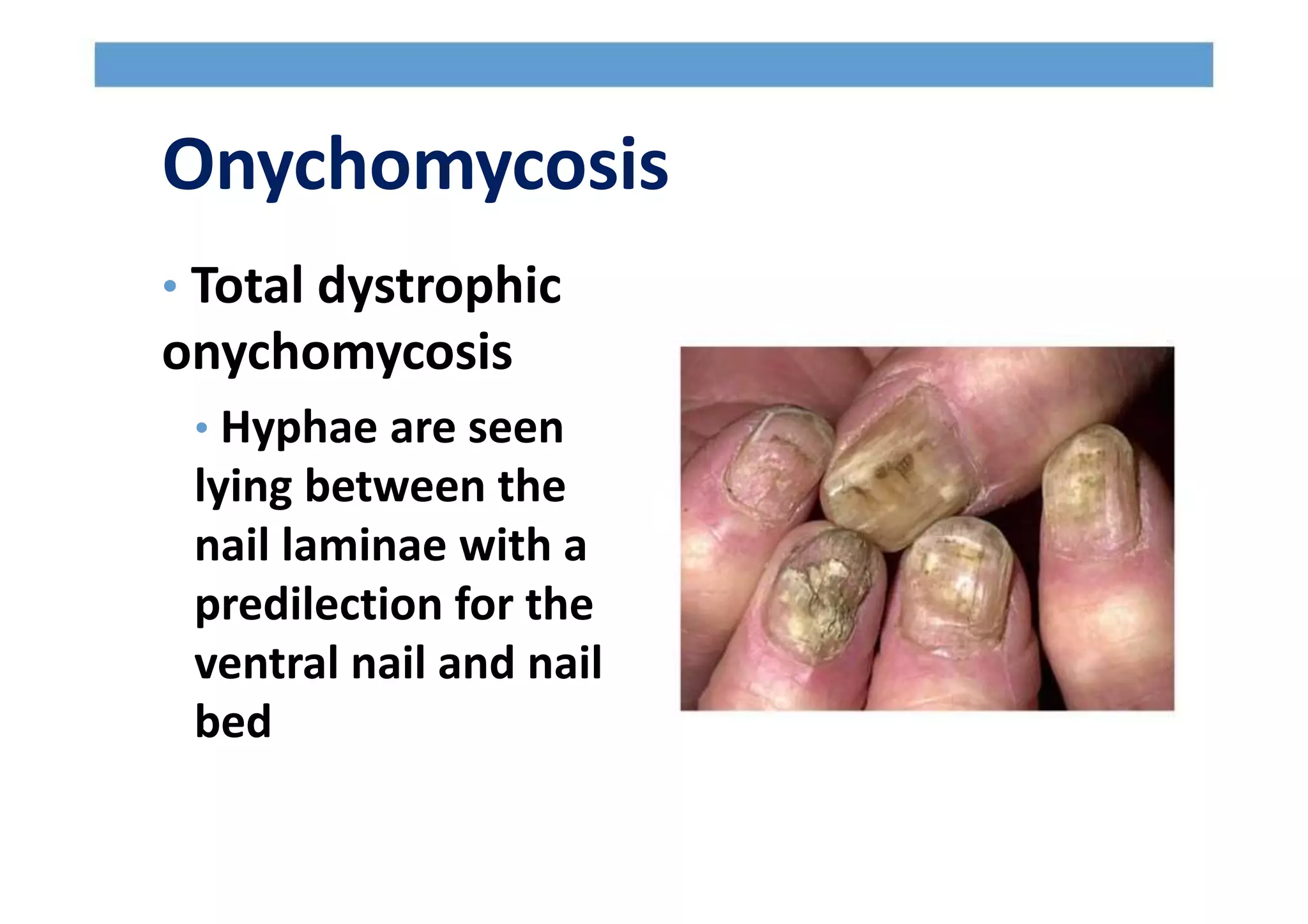 Pathology of fungal infection | PPTX
