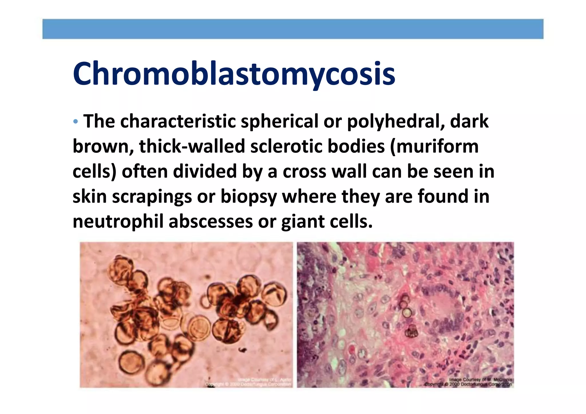Pathology of fungal infection | PPTX