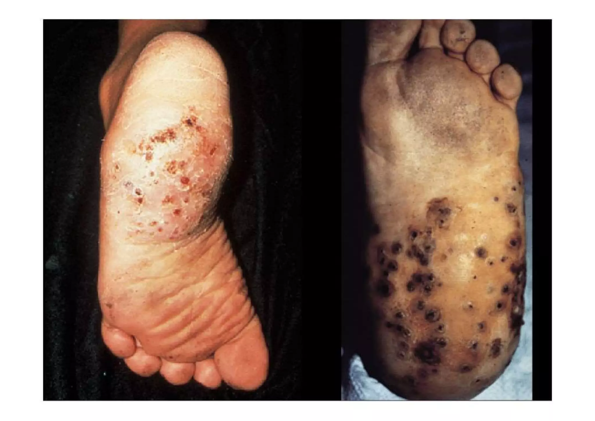 Pathology of fungal infection | PPTX