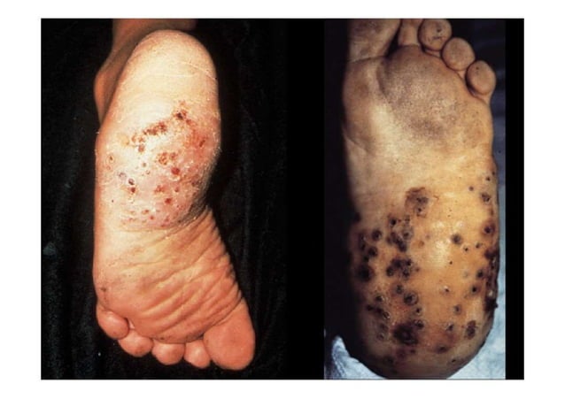 Pathology of fungal infection | PPTX | Skin and Dermatology | Diseases ...