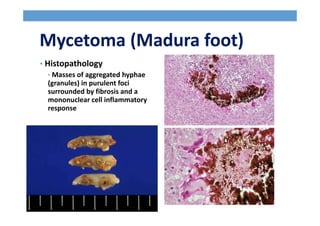 Pathology of fungal infection | PPTX