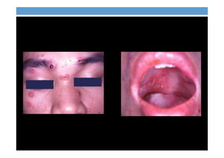 Pathology of fungal infection | PPTX