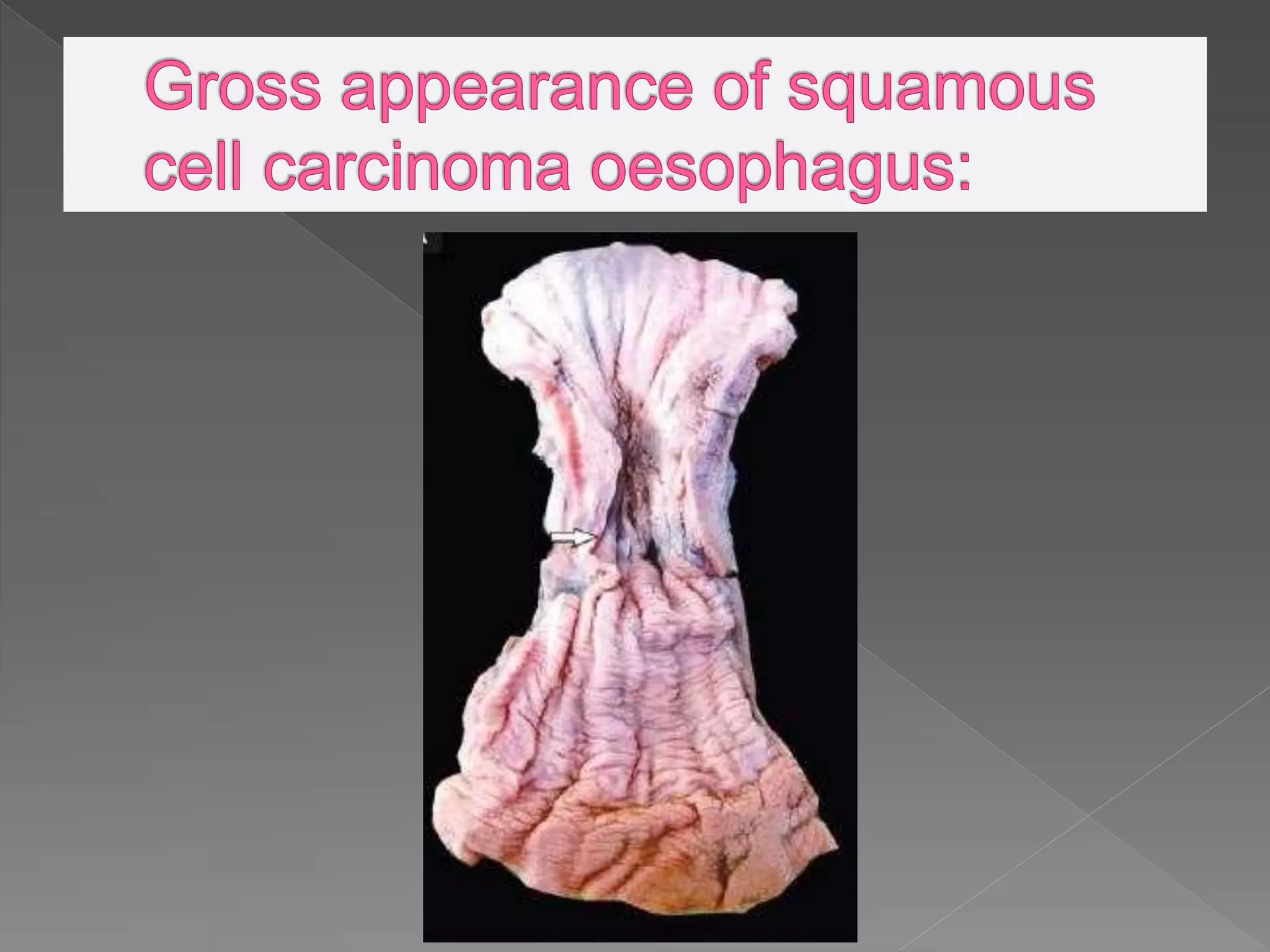 PATHOLOGY OF GASTROINTESTINAL TRACT( Oesophagus).pptx