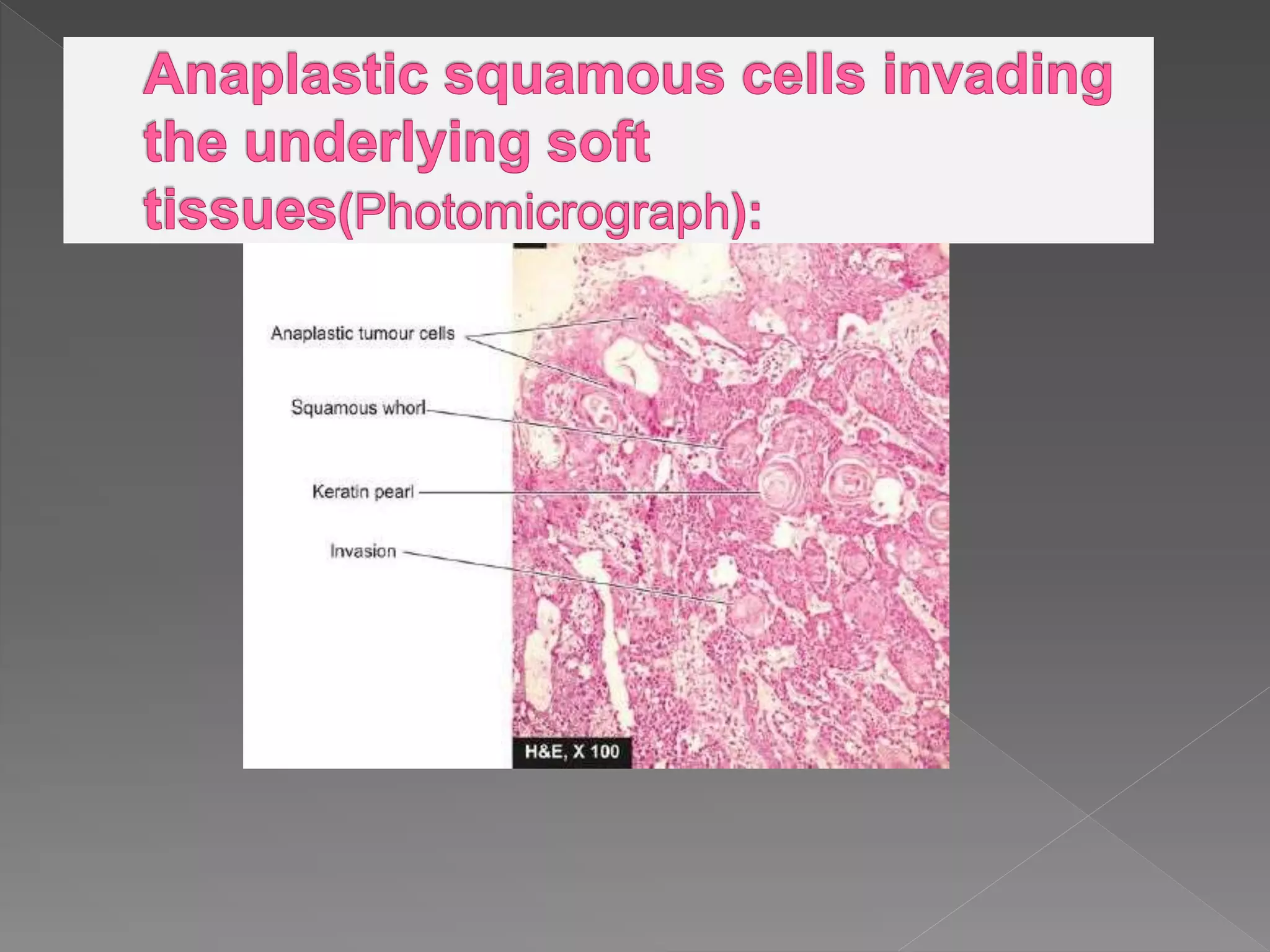 PATHOLOGY OF GASTROINTESTINAL TRACT( Oesophagus).pptx