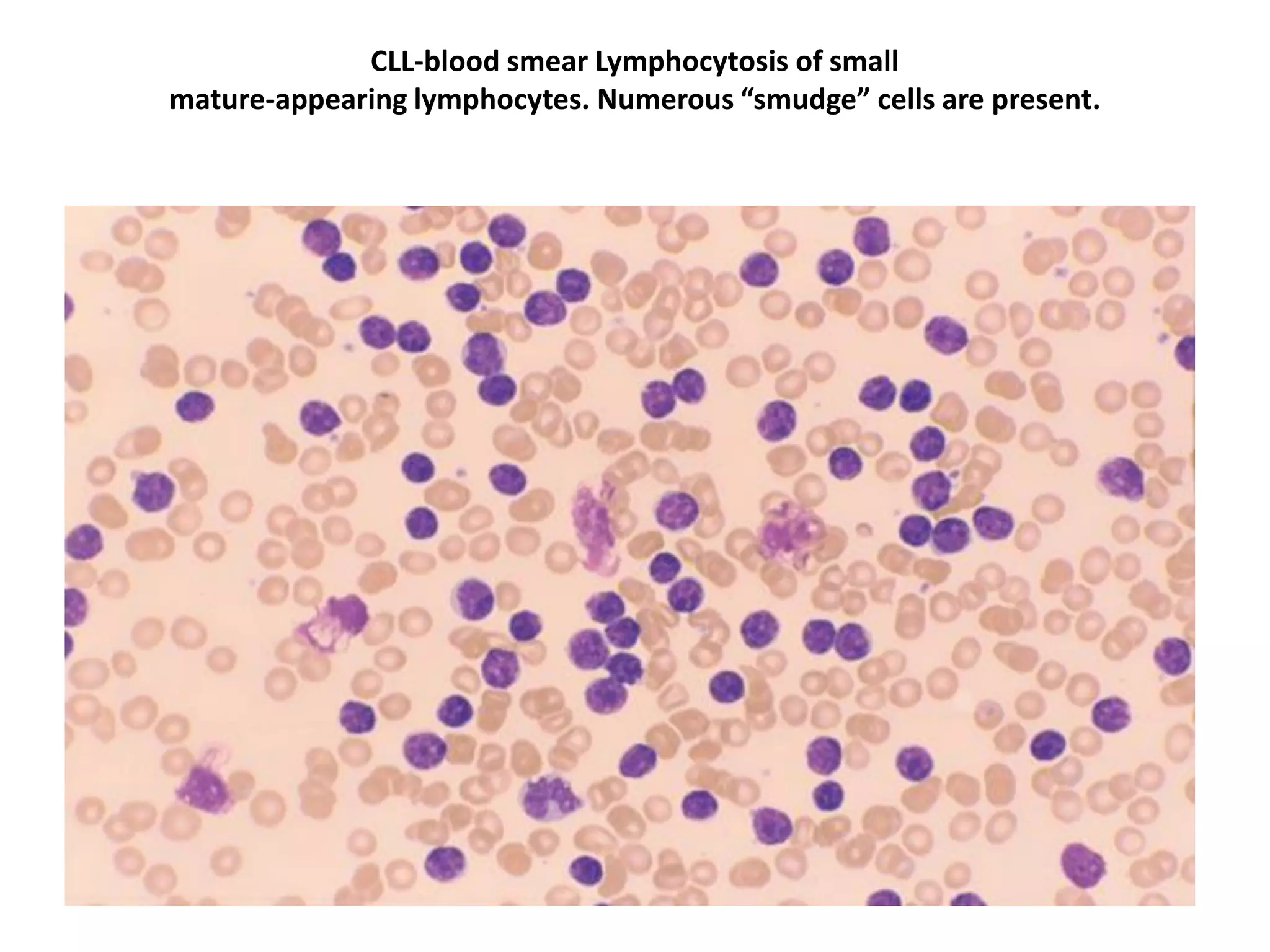 Pathology of hematolymphoid system | PDF