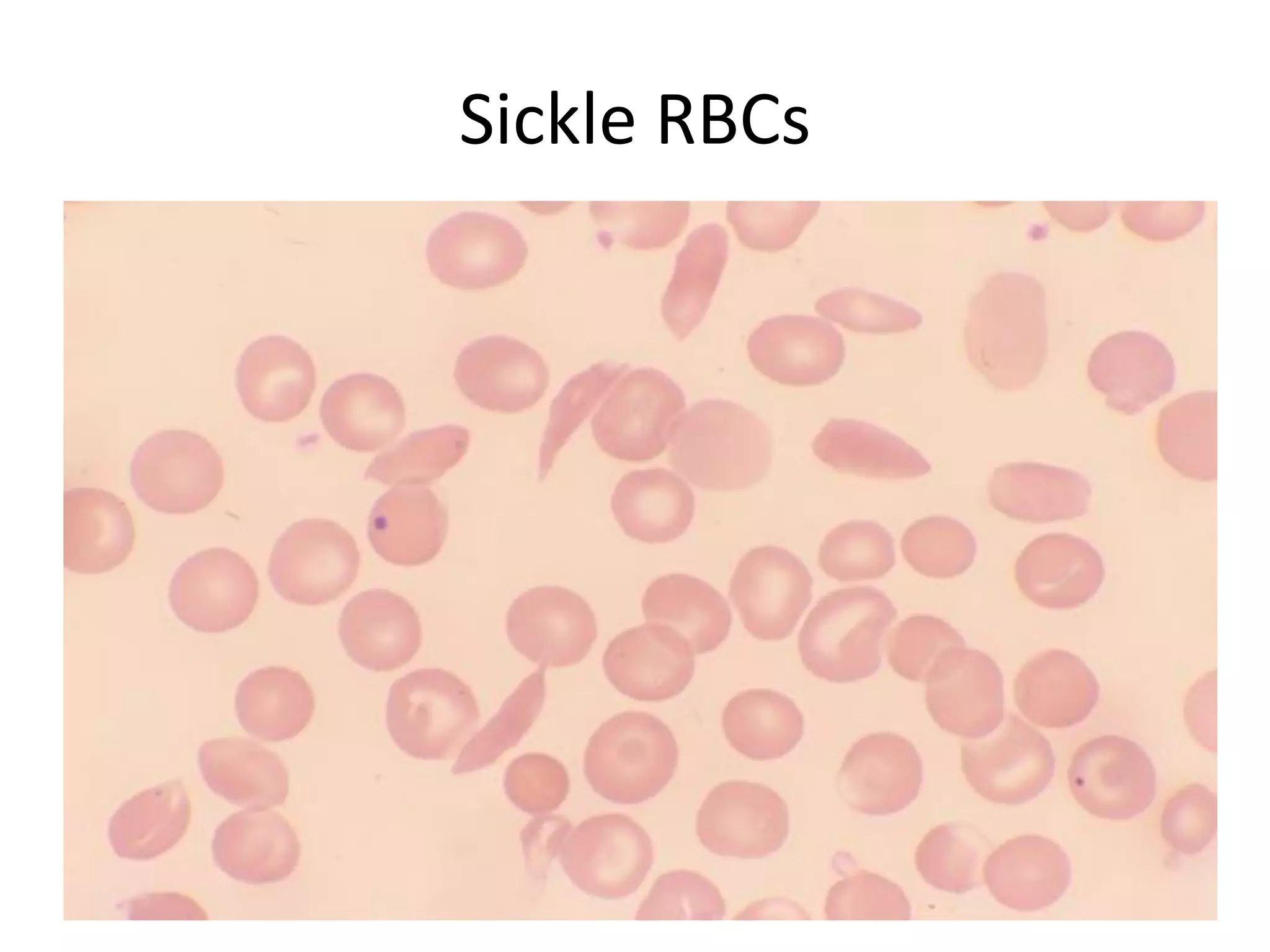 Pathology of hematolymphoid system | PDF