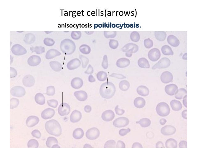 Pathology of hematolymphoid system
