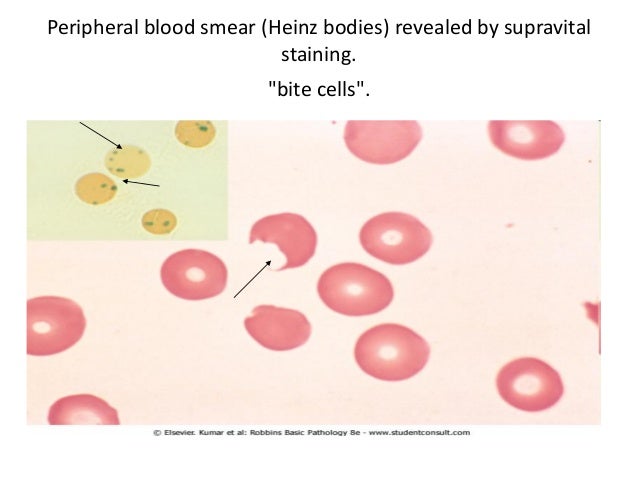 Pathology of hematolymphoid system