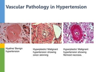 PATHOLOGY OF HYPERTENSION .ppt