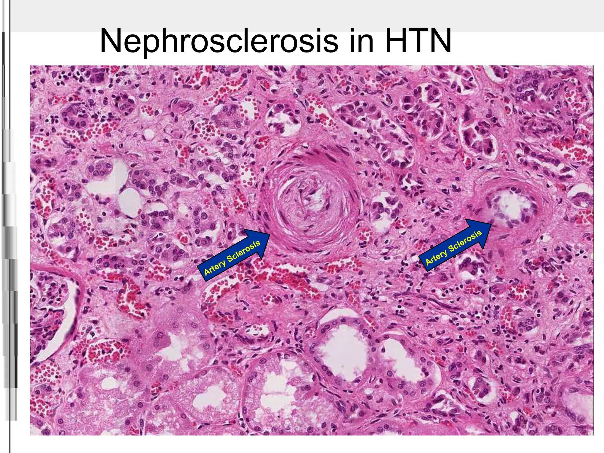 Pathology of hypertention.pptx