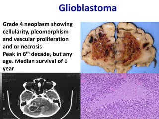 Pathology of intracranial tumors lecture | PDF