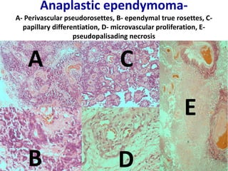Pathology of intracranial tumors lecture | PDF