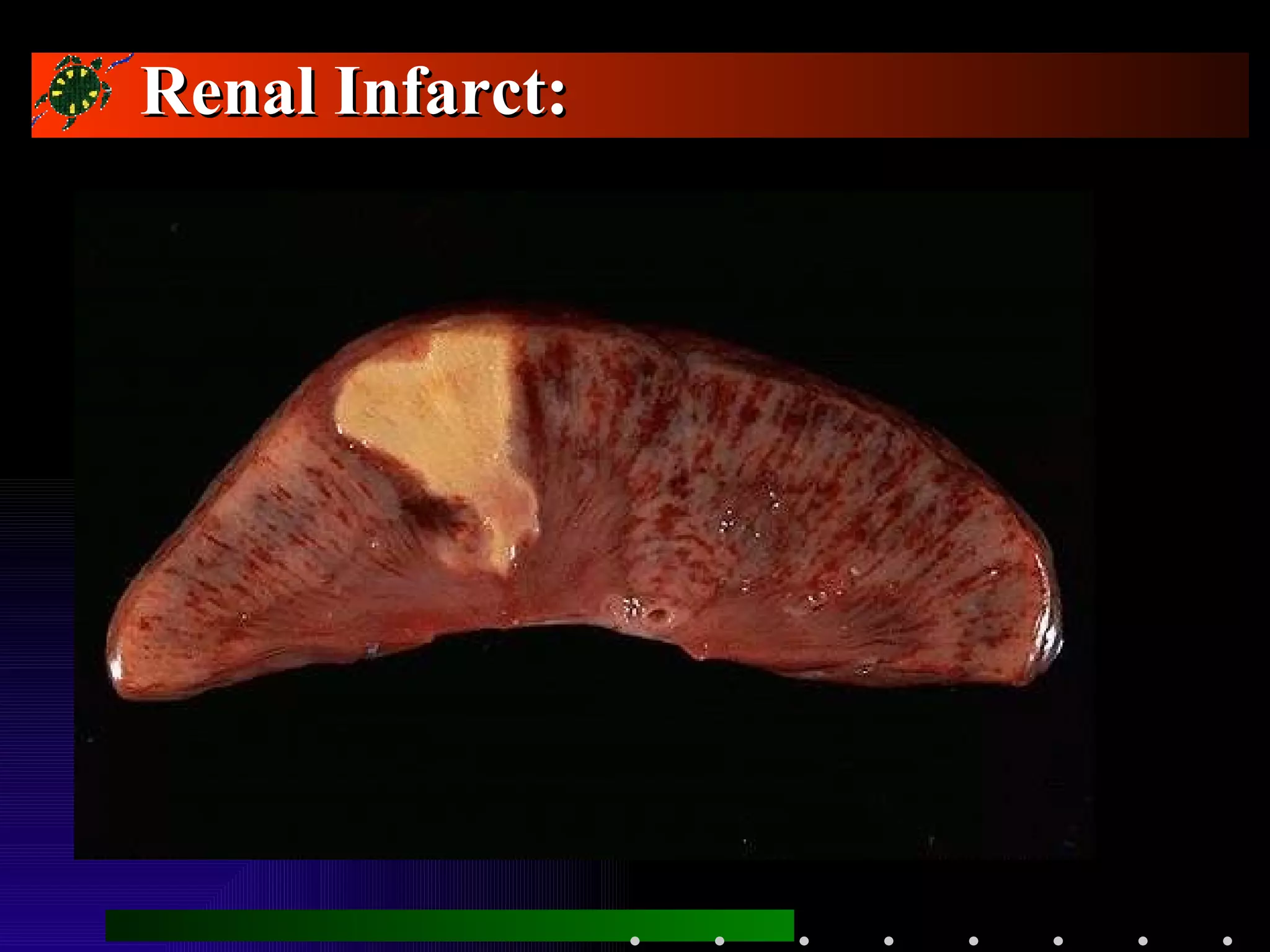 Pathology Of Kidney | PPT