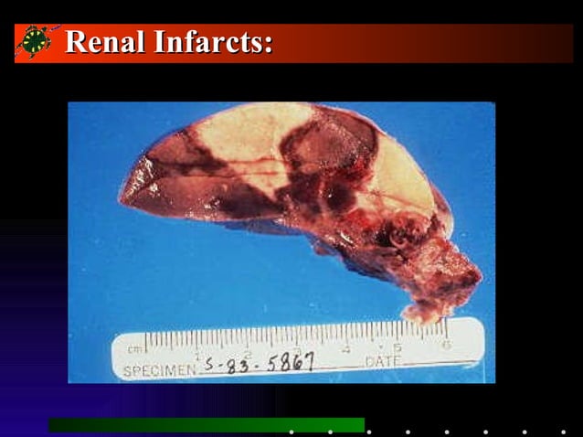 Pathology Of Kidney | PPT | Blood Disorders | Diseases and Conditions