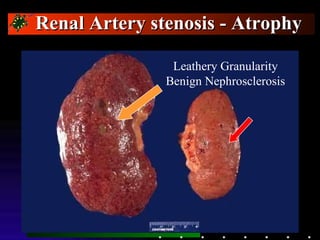 Causes Of Atrophic Kidney