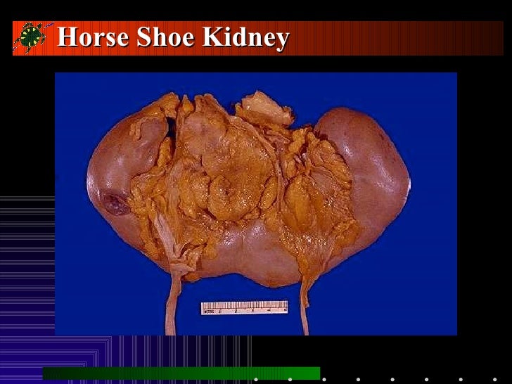 Pathology Of Kidney