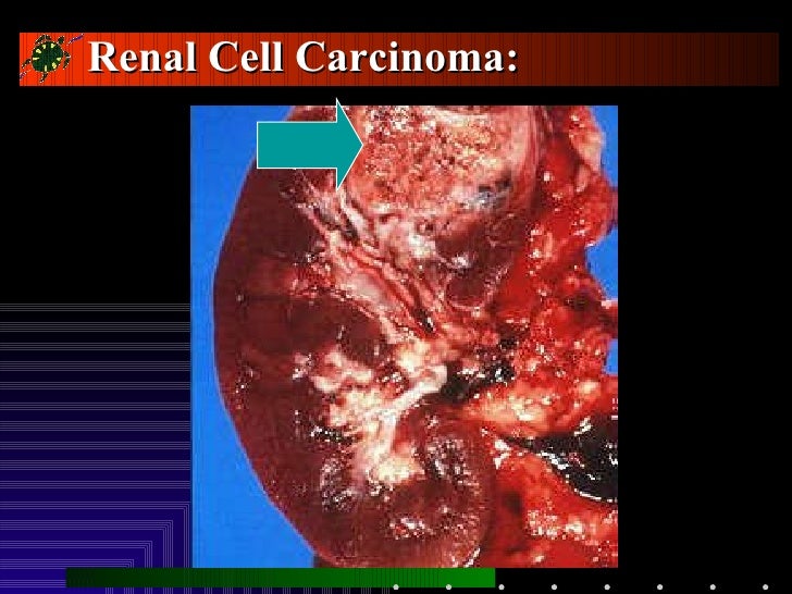 Pathology Of Kidney
