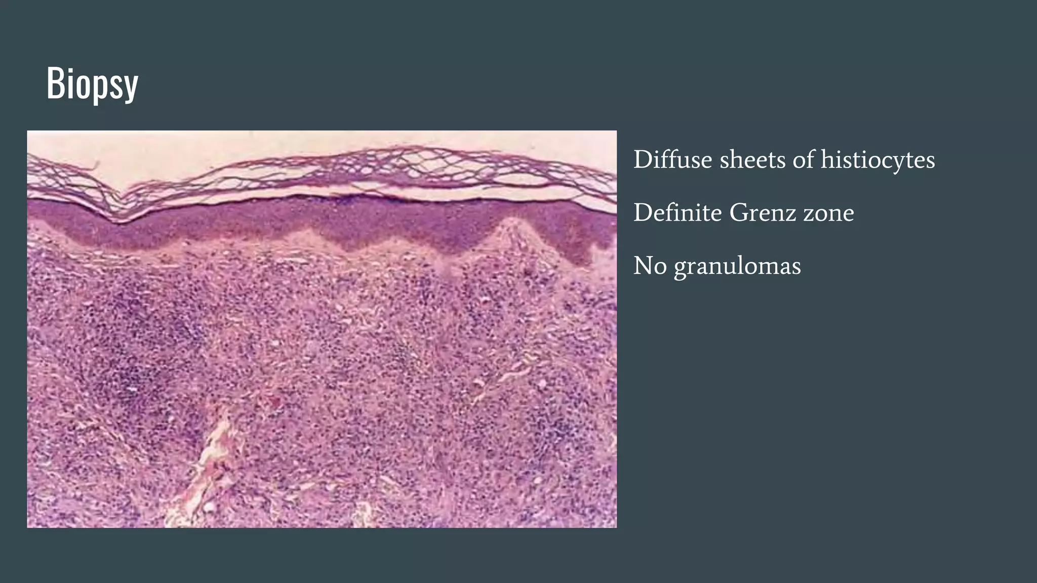 Pathology of Leprosy.pptx