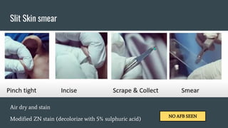 Pathology of Leprosy.pptx