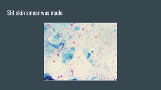 Pathology of Leprosy.pptx