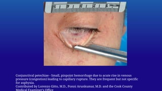 Pathology of mechanical asphyxia - a brief overview | PPTX