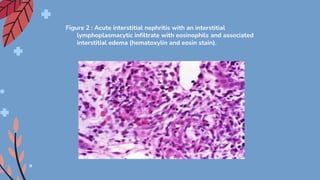 pathology of nephritis ppt.pptx