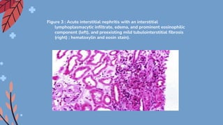 pathology of nephritis ppt.pptx
