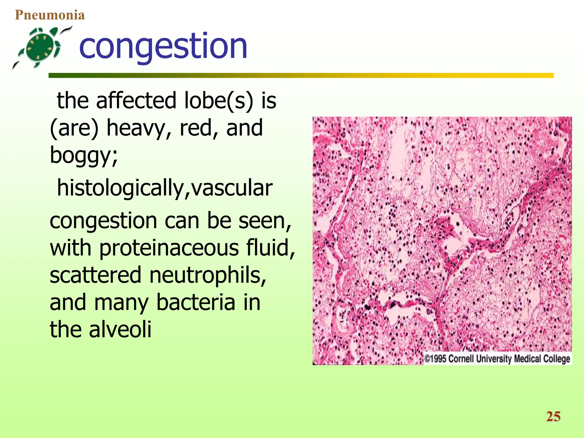 Pathology of Pneumonia POWERPOINT PRESENTATION | PPT