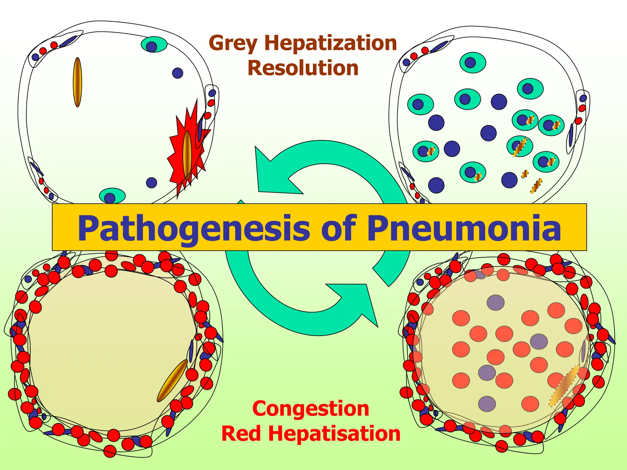 Pathology of Pneumonia POWERPOINT PRESENTATION | PPT