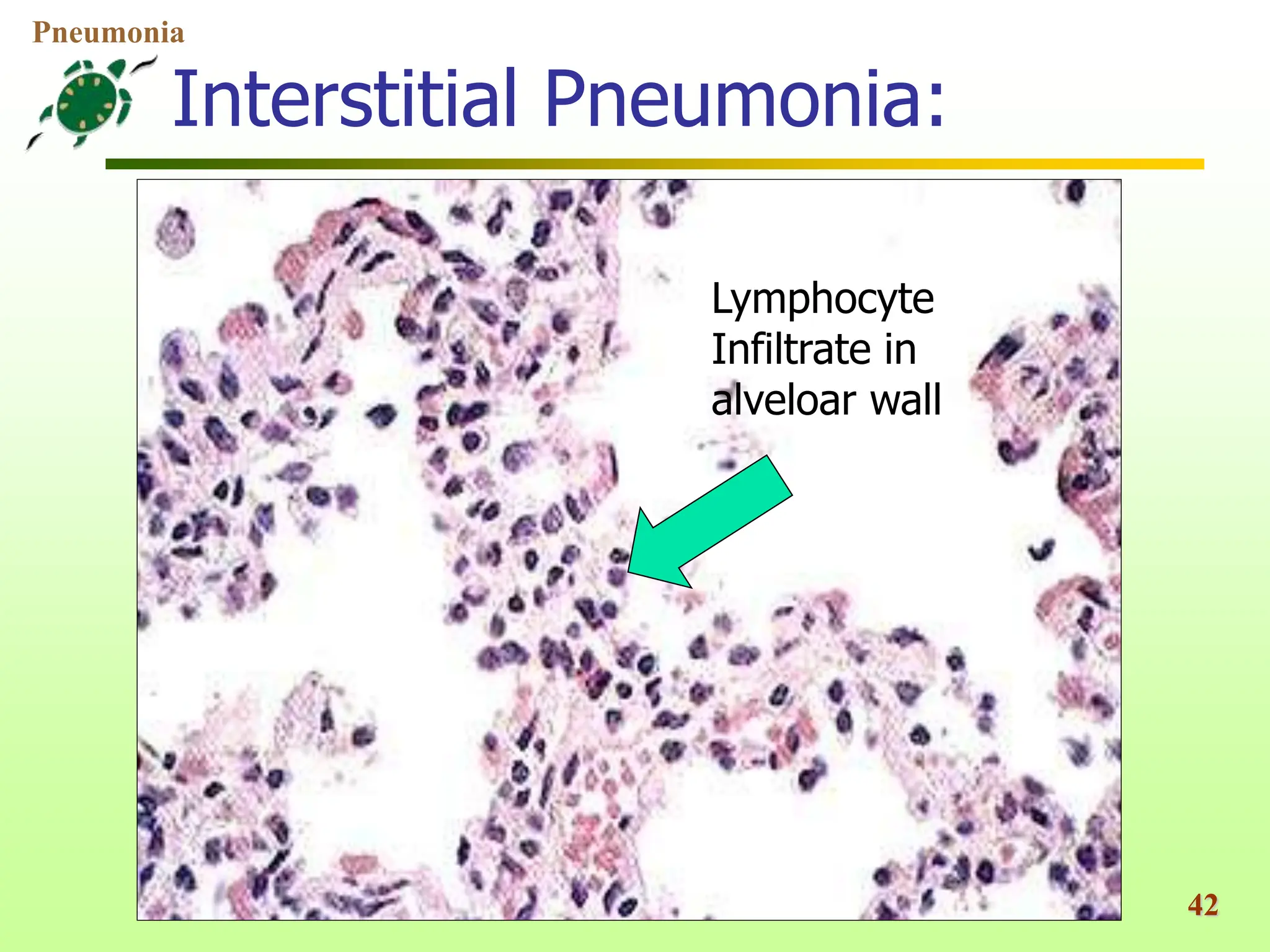 Pathology of Pneumonia POWERPOINT PRESENTATION | PPT