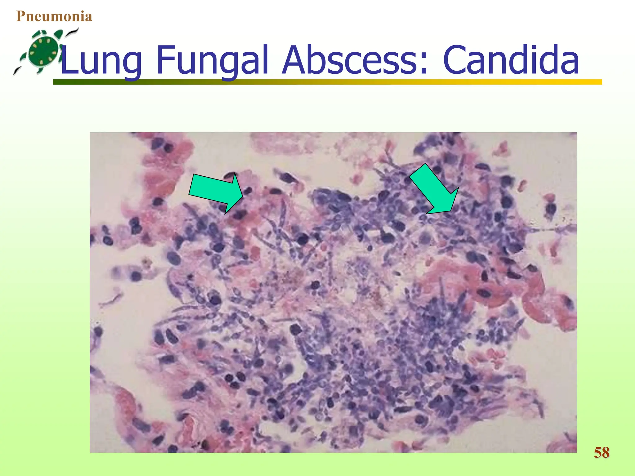 Pathology of Pneumonia POWERPOINT PRESENTATION | PPT