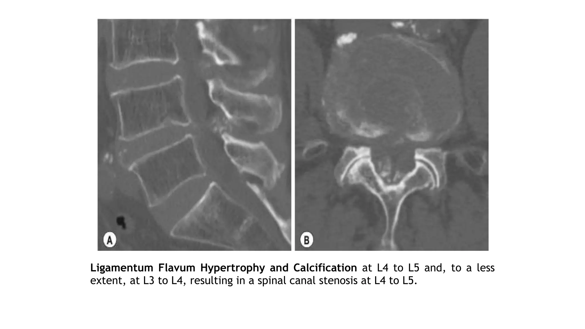 Pathology of posterior elements.pptx