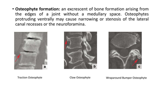 Pathology of posterior elements.pptx | Death, Injury, or Military ...