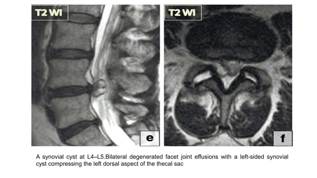Pathology of posterior elements.pptx | Death, Injury, or Military ...