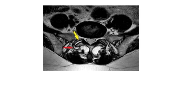 Pathology of posterior elements.pptx | Death, Injury, or Military ...