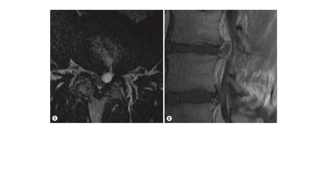 Pathology of posterior elements.pptx | Death, Injury, or Military ...