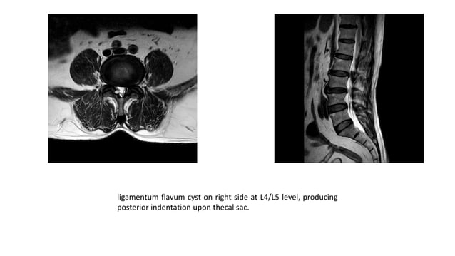 Pathology of posterior elements.pptx | Death, Injury, or Military ...