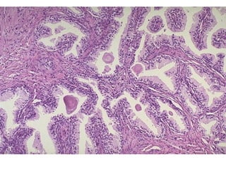 Pathology of prostate | PPT