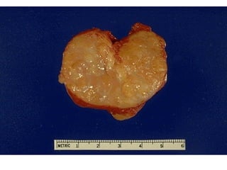 Pathology of prostate | PPT