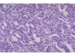 Pathology of prostate | PPT