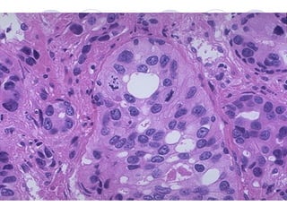 Pathology of prostate | PPT