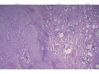 Pathology of prostate | PPT