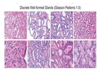 Pathology of prostate | PPT