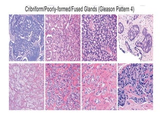 Pathology of prostate | PPT