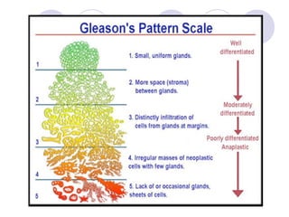 Pathology of prostate | PPT