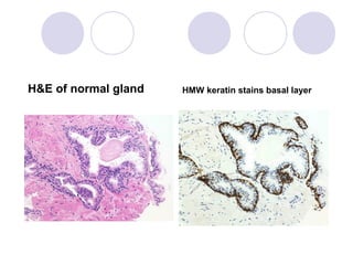 Pathology of prostate | PPT