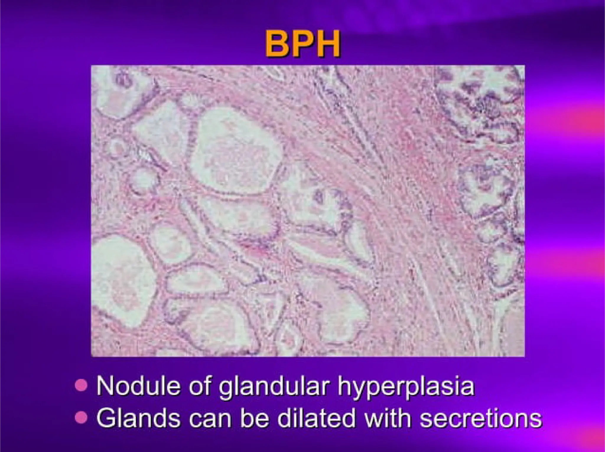 Prostate Pathophysiology23.ppt prostate cancer prostatic hyperplasia | PDF
